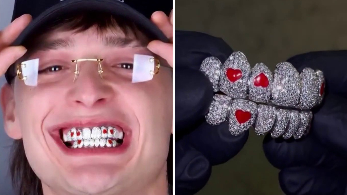Los dientes de Peso Pluma: dentista explica cómo creó la funda dental ...